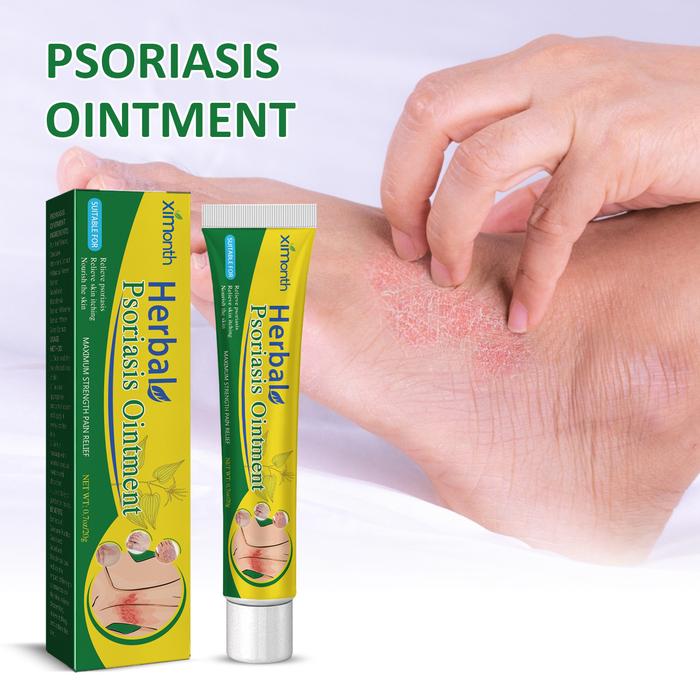 Promo Eczema Treatment Cream Inhibit Dermatitis Urticaria Desquamation ...