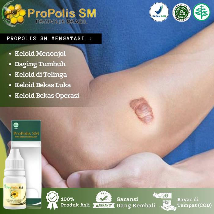 Jual Propolis SM Obat Keloid Menonjol, Daging Tumbuh, Keloid Bekas Luka ...