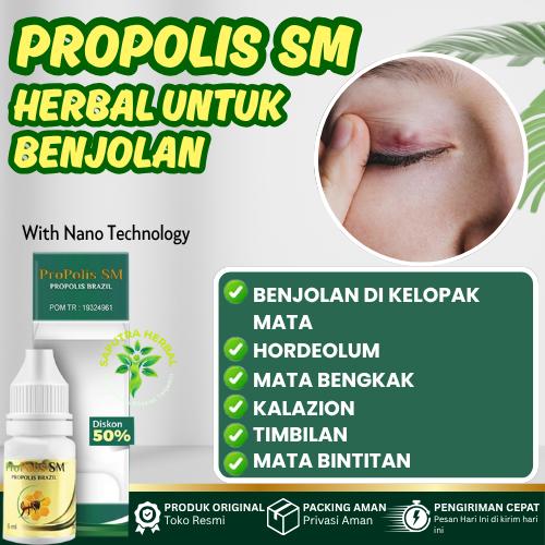 Promo Atasi Benjolan Di Kelopak Mata Kalazion Mata Bintitan Hordeolum ...