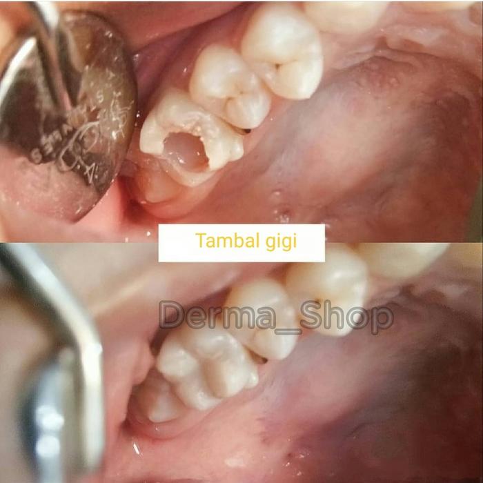 Jual Penambal Gigi Berlubang Tambal Gigi Patah Berlubang Ompong isi 500 - Jakarta Timur ...