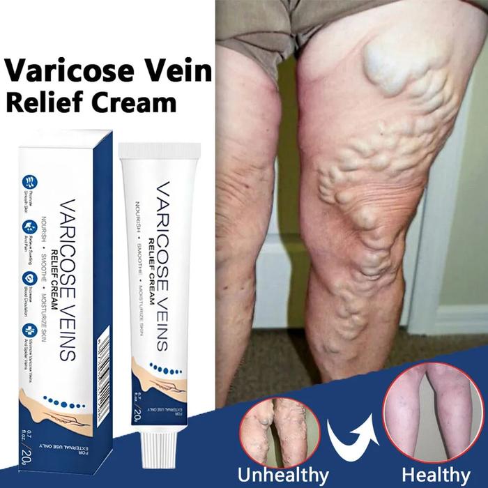 Jual Effective Varicose Veins Cream Relieve Vasculitis Phlebitis Spider ...