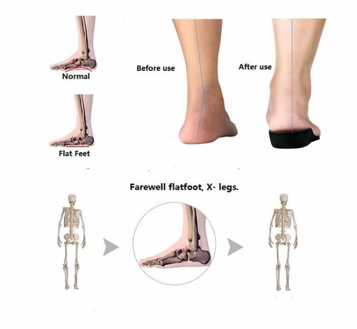 Jual Alas Kaki Sepatu Empuk Insole Flat Foot Arch Support Orthotic II ...