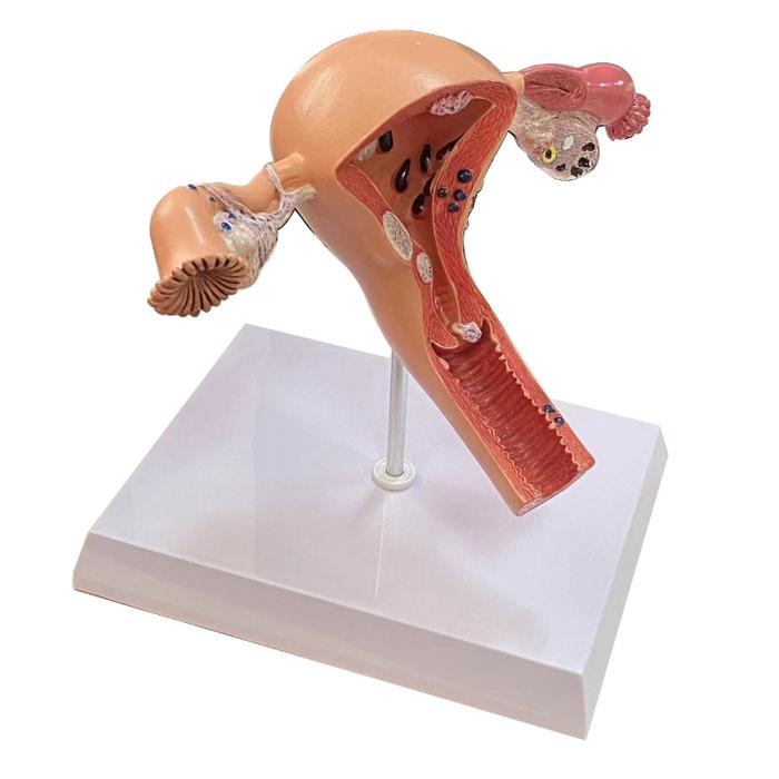 Jual Model Ovarium Rahim Patologis Manusia Anatomi Anatomi Penyakit ...