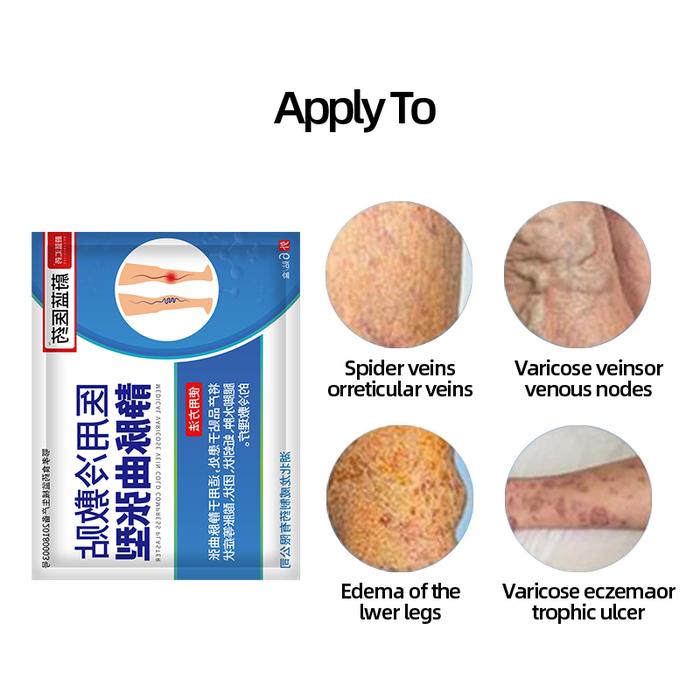 Jual Varicose Veins Treatment Patch Vasculitis Relief Sticker Spider ...