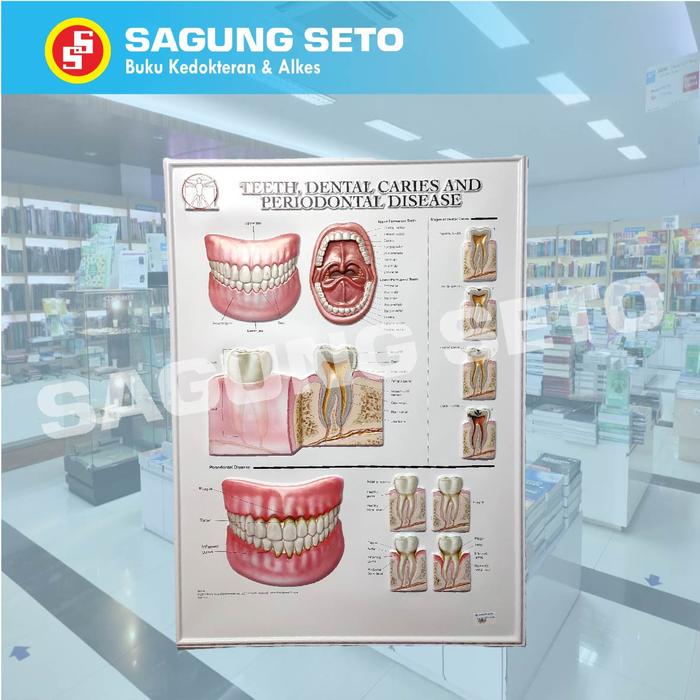 Promo POSTER TEETH DENTAL CARIES AND PERIODONTAL DISEASE 3D / POSTER ...