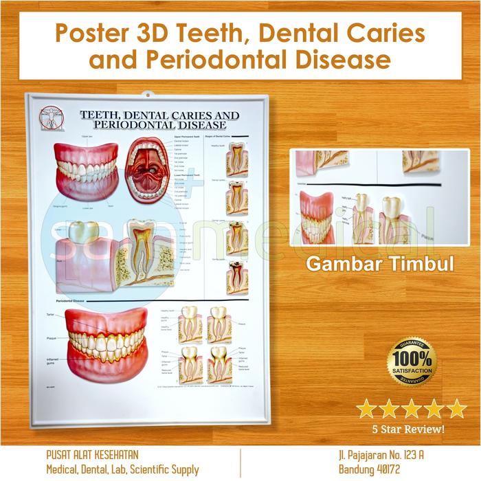 Jual Poster 3D Teeth, Dental Carries and Periodontal Disease BS 148RR ...